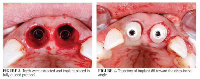 Angled Screw-Retained Crowns Advance Esthetics and Function - Decisions ...