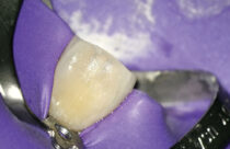 Improve Restorability With Orthodontic Extrusion - Decisions in Dentistry