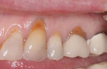 Angled Screw-Retained Crowns Advance Esthetics and Function - Decisions ...