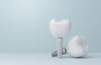 Effectively Addressing External Root Resorption - Decisions in Dentistry