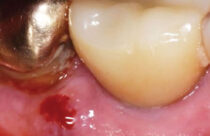 Mastering Subgingival Calculus Removal - Decisions in Dentistry