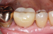 Making the Most of the New Periodontal Classification System ...