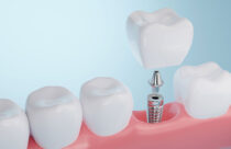 Making the Most of the New Periodontal Classification System ...