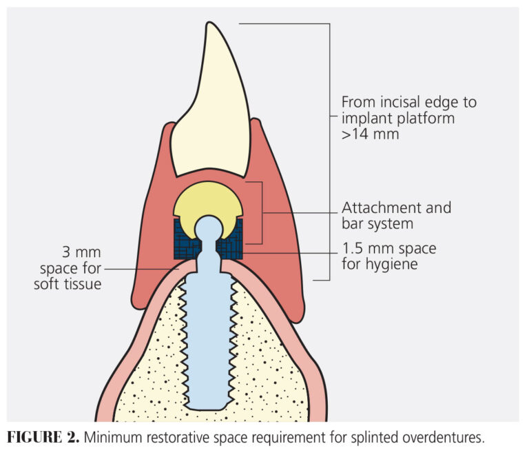 Simplifying the Confusion of Overdenture Restorative Space - Decisions ...