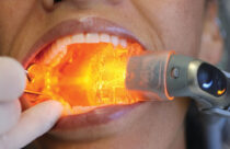 Properly Developing Line Angles - Decisions in Dentistry