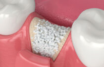 Effectiveness of Bleaching Agents Used in the Walking Bleach Technique ...