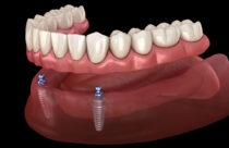 Fixed Retention in Orthodontics - Decisions in Dentistry