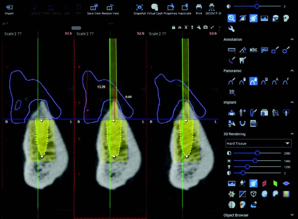 Simplifying the Confusion of Overdenture Restorative Space - Decisions ...