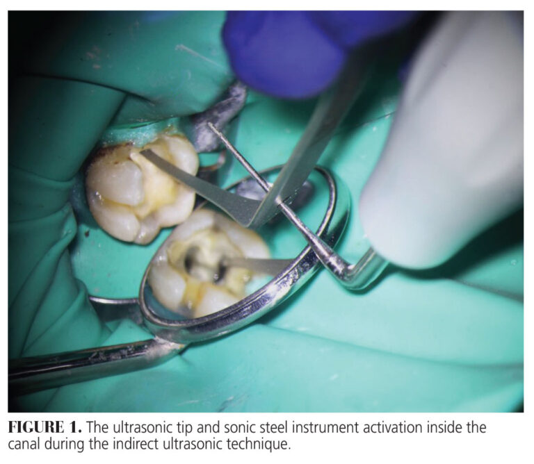 Mastering the Art of Broken File Retrieval in Endodontics - Decisions ...