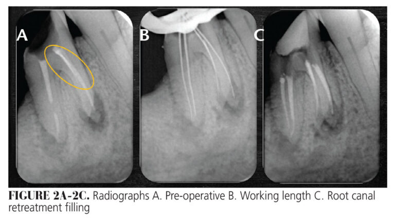 Mastering the Art of Broken File Retrieval in Endodontics - Decisions ...