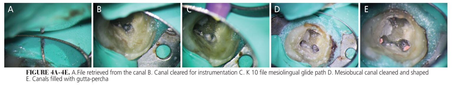 Mastering the Art of Broken File Retrieval in Endodontics - Decisions ...