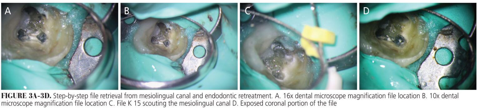 Mastering the Art of Broken File Retrieval in Endodontics - Decisions ...