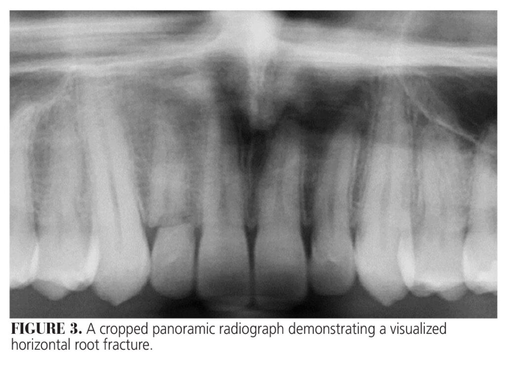 Conservative Management of Horizontal Root Fractures - Decisions in ...