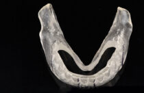 Improve Restorability With Orthodontic Extrusion - Decisions in Dentistry