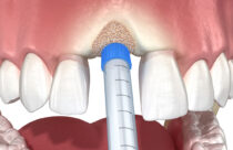 Mastering Subgingival Calculus Removal - Decisions in Dentistry