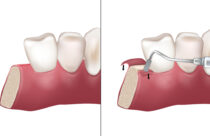 Mastering Subgingival Calculus Removal - Decisions in Dentistry