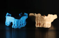 Semi-Precision Root Anchors For Partial Dentures - Decisions in Dentistry