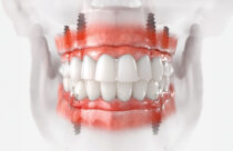 Semi-Precision Root Anchors For Partial Dentures - Decisions in Dentistry