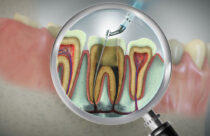 Effectively Addressing External Root Resorption - Decisions in Dentistry