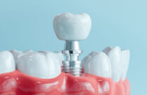 Effectively Addressing External Root Resorption - Decisions in Dentistry