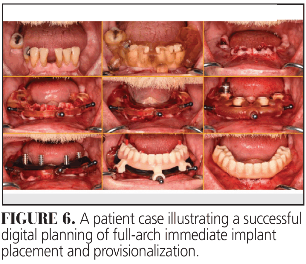 Precision Planning in Full-Arch Implant Rehabilitation - Decisions in ...