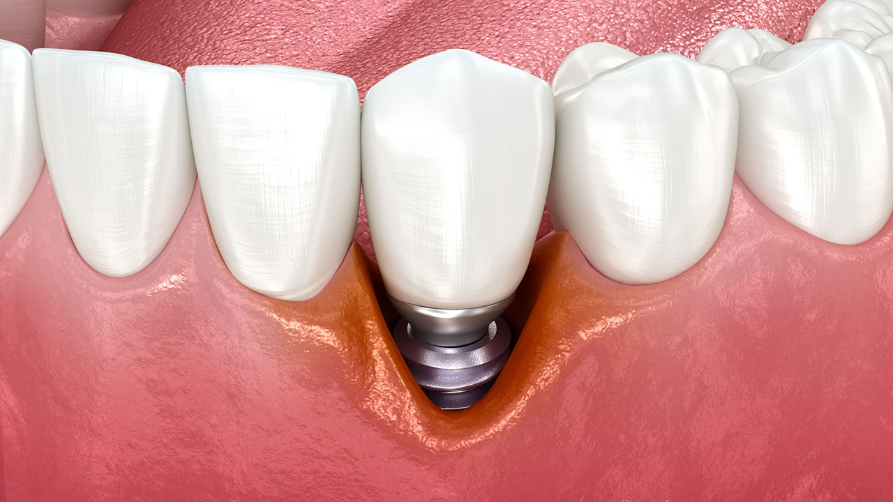 New Consensus Charts Clear Path for Managing Peri-Implant Diseases ...