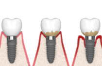 Effectively Addressing External Root Resorption - Decisions in Dentistry
