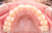 Effectively Addressing External Root Resorption - Decisions in Dentistry