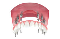 Effectively Addressing External Root Resorption - Decisions in Dentistry