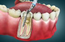 A Glimpse Into the Oral Hygiene Regimens of Ancient Romans - Decisions ...