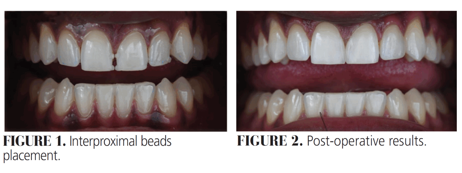 Redefining Diastema and Black Triangle Closures - Decisions in Dentistry