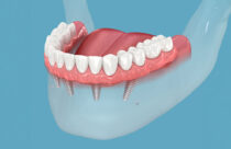 Fixed Retention in Orthodontics - Decisions in Dentistry