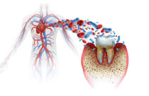 Oral Manifestations of Tuberculosis - Decisions in Dentistry