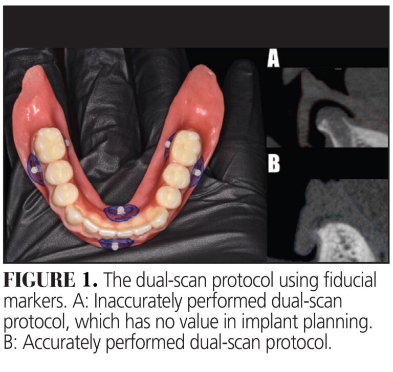 Why the Dual-Scan Protocol Sets Your Implant Plan Up for Success ...