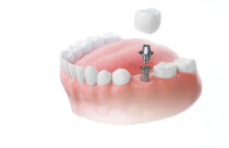 Angled Screw-Retained Crowns Advance Esthetics and Function - Decisions ...